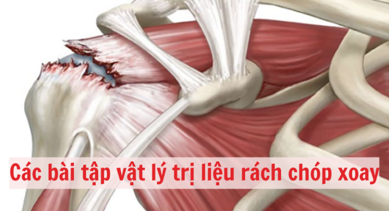 Tập vật lý trị liệu rách chóp xoay hiệu quả - Phòng Khám Cơ Xương Khớp HTC